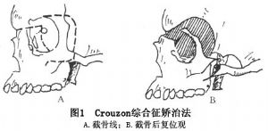 Crouzon综合征_Crouzon综合征的病因病机、临床表现、诊断、治疗_医学百科